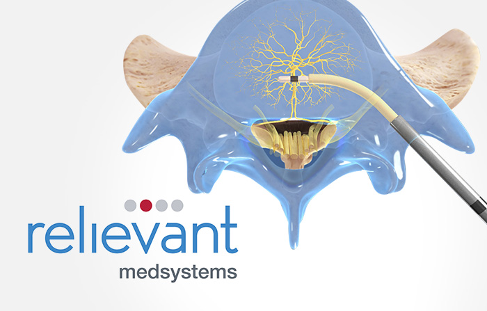 Relievant celebrates positive results for Intracept® Procedure Relievant celebrates positive results for Intracept® Procedure